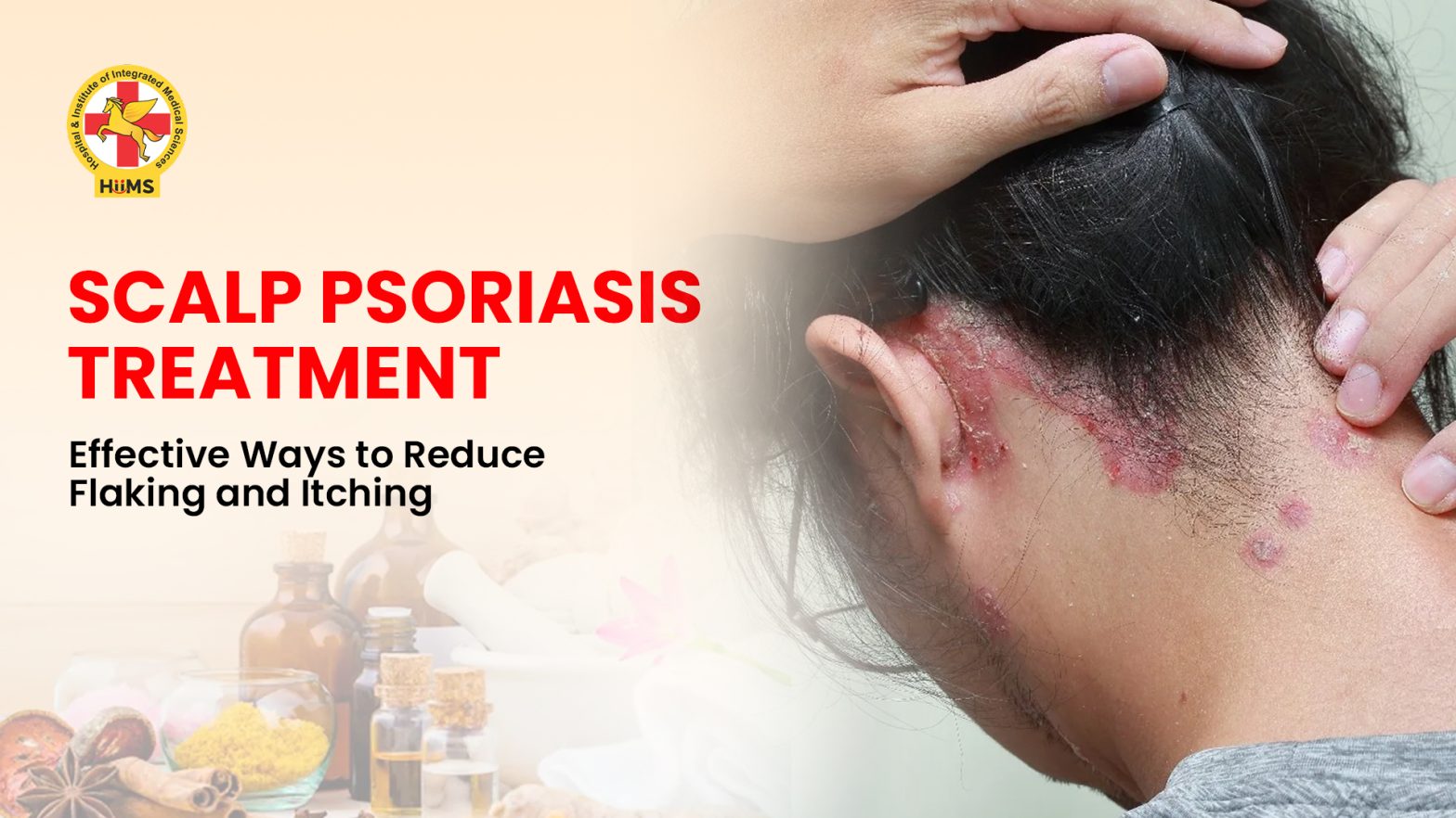 Scalp Psoriasis Treatment for Reduced Flaking & Itching