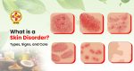 Skin Disorder: Causes, Symptoms & Natural Treatment